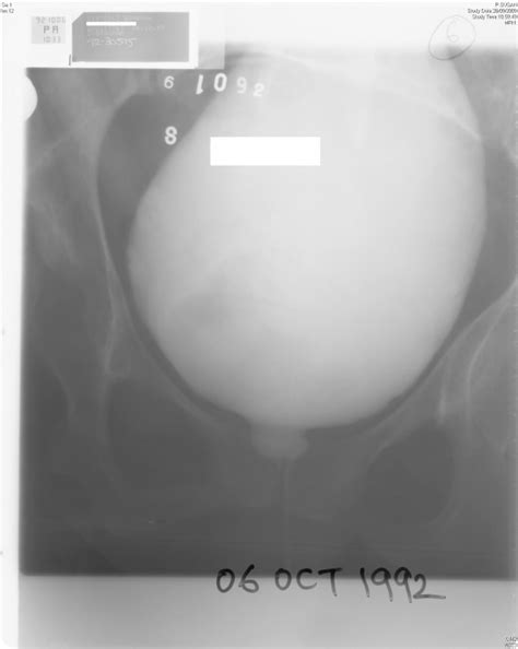 Cystogram Done On 06 October 1992 Revealed A Large Capacity Bladder