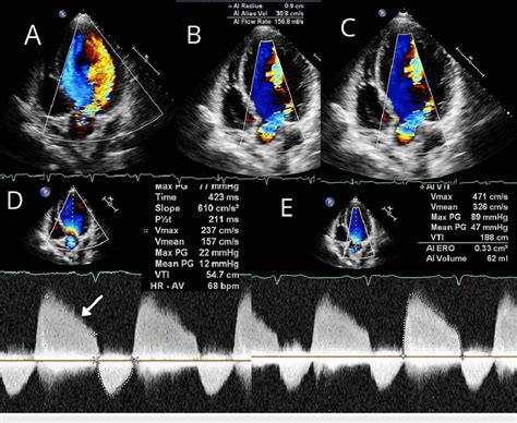 Aortic Regurgitation Echo