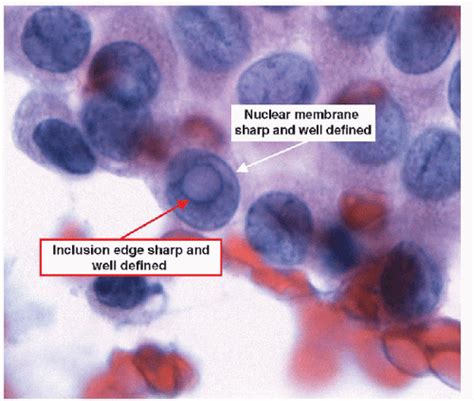 Papillary Lesions Oncohema Key