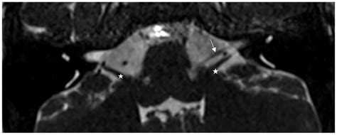 Axial Image Of High Resolution T2 Weighted Three Dimensional Sequence Download Scientific