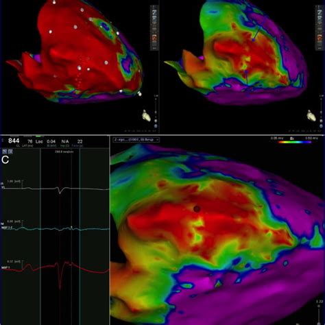 Carto Univu Image Showing Electroanatomic Voltage Map In The Right