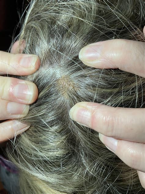 Strange Like Mole Or Lesion On Scalp Looks Like Brains Or Clusters
