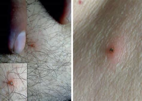 What Do Ticks Look Like 23 Pictures Of Ticks In All Life Stages Pest