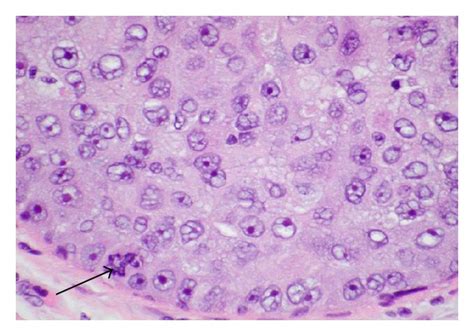 High Grade Dcis With Atypical Pleomorphic Nuclei And Prominent Nucleoli Download Scientific