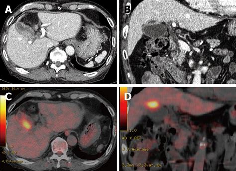 Xanthogranulomatous Cholecystitis Mimicking Gallbladder
