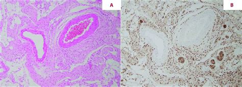 Hematoxylin And Eosin Staining A And S 100 Immunoperoxidase