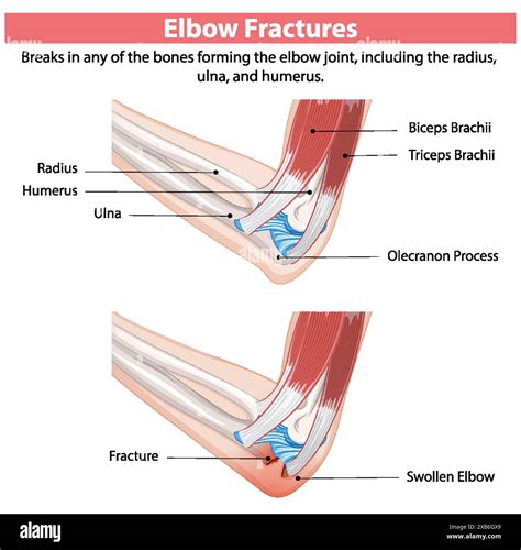 Diagram Showing Types Of Elbow Fractures Stock Vector Image And Art Alamy