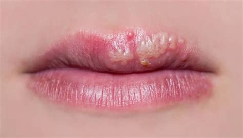 Herpes Simpleks Je Virusna Infekcija Zašto Nastaje I Kako Ga Liječiti