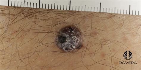 Melanoma Nodular Clínica Dôvera