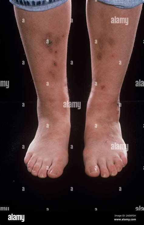 White Atrophy Close Up Of The Legs Of A Patient With White Atrophy White Atrophy Close Up Of The Legs Of A Patient With White Atrophy