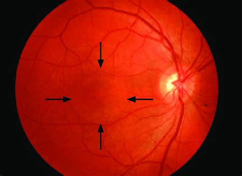 Fundus Photograph Of Serous Detachment Of The Neurosensory Retina Of