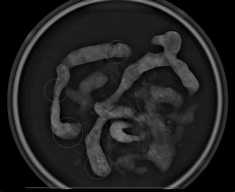 Amorphous Calcifications Radiology Key