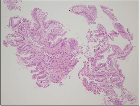 Histologic Findings Of Distal Common Bile Duct Hande ×100 Chronic