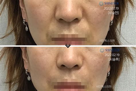 팔자주름필러 피코토닝 전후사진 대전둔산 샤인톡스의원