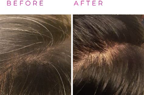 Iscalp Scalp Detoxification Treatment