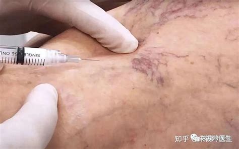 腿部毛细血管扩张症怎么治疗 知乎