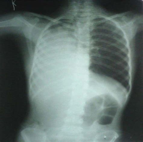 Chest X Ray Showing Atelectasis Of Right Lung Download Scientific Diagram Chest X Ray Showing Atelectasis Of Right Lung Download Scientific Diagram