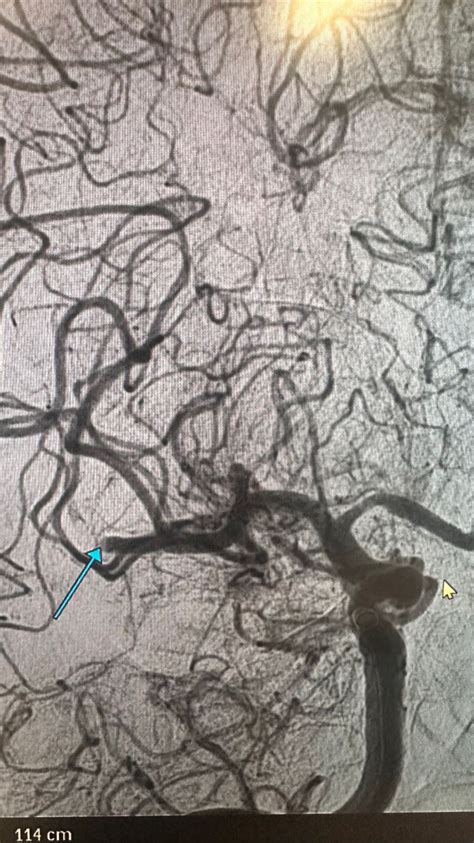 Two M2 Segment Occlusion And Thrombectomies Last Night Sumeet Singh Multani Md Mbbs