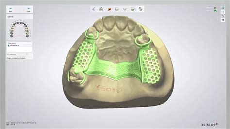 A Systematic Approach For Removable Partial Denture Design At John