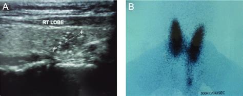 Ultrasonography Of The Thyroid Gland Demonstrating An Inhomogeneous Download Scientific