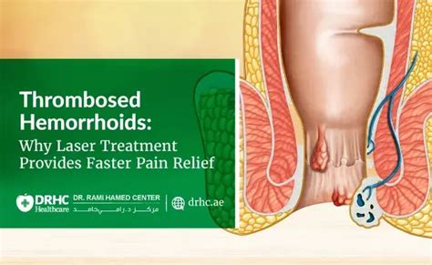 How Long Does It Take A Thrombosed Hemorrhoid To Heal Detroit Chinatown