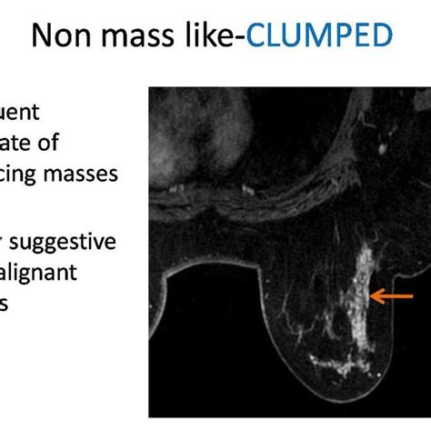 Non Mass Clumped Enhancement Download Scientific Diagram