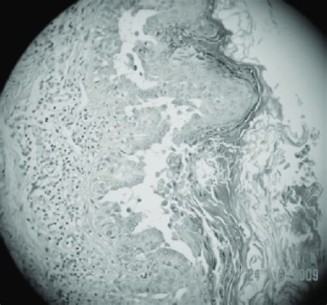 Histopathologic View From Retroauricular Area Shows Typical Download Scientific Diagram