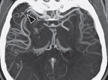 10 Thrombolysis Of M1 Middle Cerebral Artery Occlusion Neupsy Key