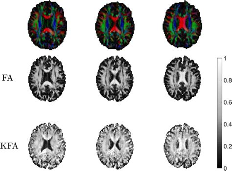 Fa And Kfa In Normal Human Brain The Top Row Shows The Fa Map With Download Scientific Diagram