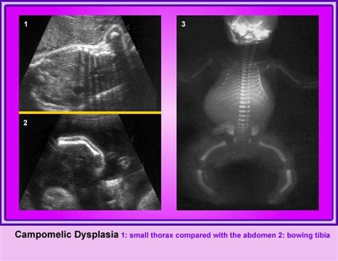 Campomelic Dysplasia Ultrasound