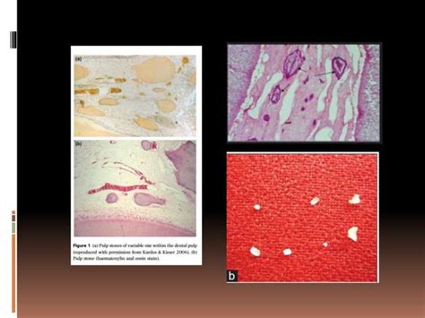 Pulp Calcification Pptx Dental Health Diseases And Conditions