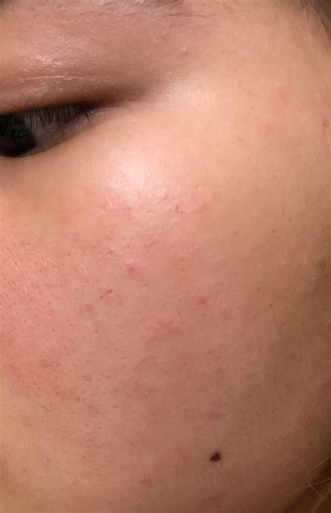 Skin Concerns I Started Using The Inkey Retinol Serum Two Days Ago