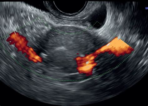 Chapter 16 Doppler Ultrasound In Gynaecology Obgyn Key