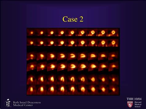 Ppt Attenuation Artifacts Powerpoint Presentation Free Download Id3380940