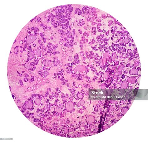 갑상선의 여포 선종 가벼운 현미경 사진 갑상선 선종의 조직 병리학 현미경 사진은 갑상선 조직을 보여줍니다 갑상샘에 대한 스톡 사진 및 기타 이미지 Istock