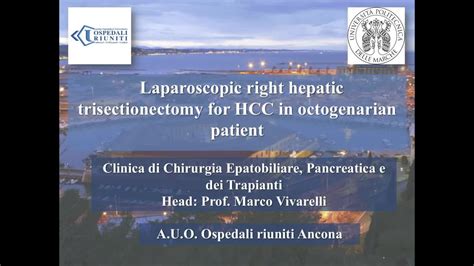 Marco Vivarelli On Linkedin Laparoscopic Right Hepatic Trisectionectomy For Hcc Federico
