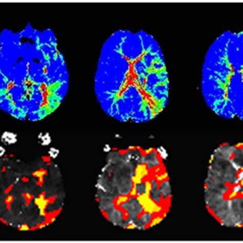 Perfusion Injury In Subacute Stroke Patients With Severe Download