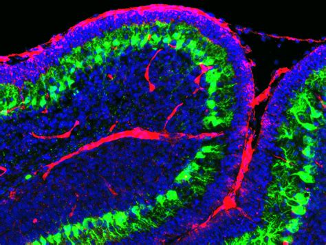 Targeting A Clotting Protein To Treat Neonatal Brain Bleeds Drug