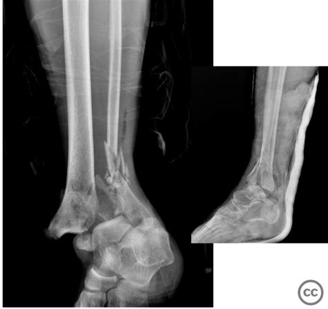Open Medial Malleolus Fracture Dislocation With Tibial Pilon And Lateral Malleolus Fractures