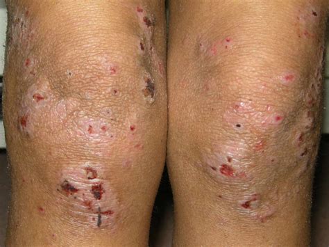 Atopic Dermatitis