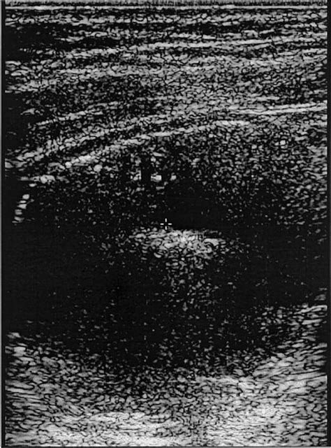 Ultrasound Image Obtained Using A 5 To 8 Mhz Transabdominal Curvilinear Download Scientific