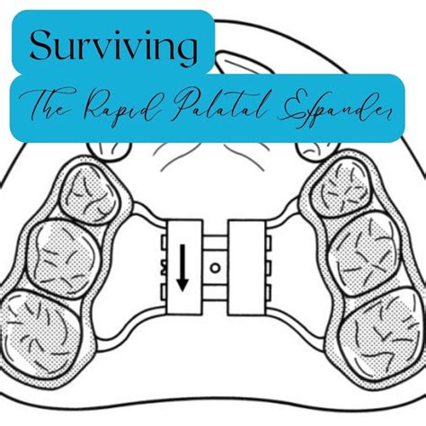 Surviving The Rapid Palatal Expander