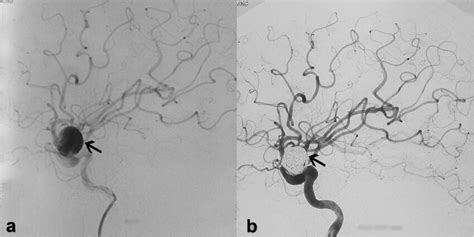 Digital Subtraction Angiography Dsa Of The Aneurysm Before And After