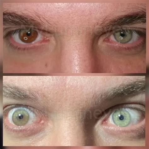 Heterochromia Treatment With Laser Causes Of Heterochromia