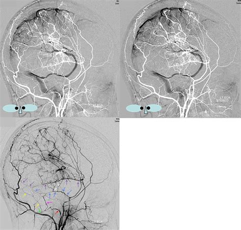 Posterior Meningeal Artery