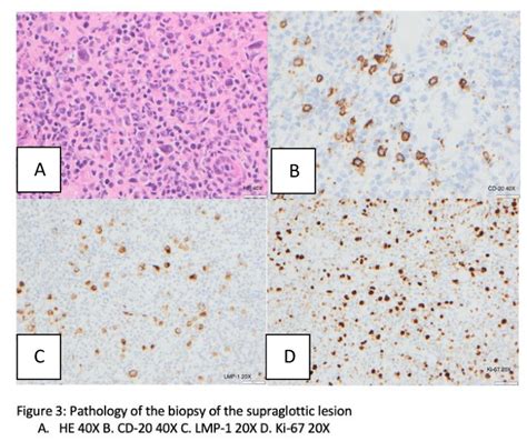 Pathology Of The Biopsy Of The Supraglottic Lesion A He 40x B
