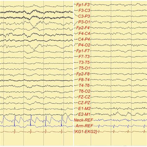 electroencephalography eeg showing diffuse background slow waves with