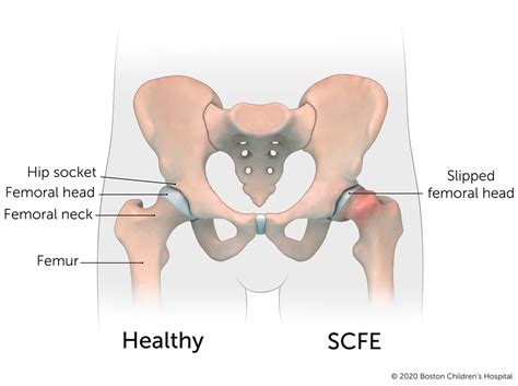 Slipped Capital Femoral Epiphysis Treatment