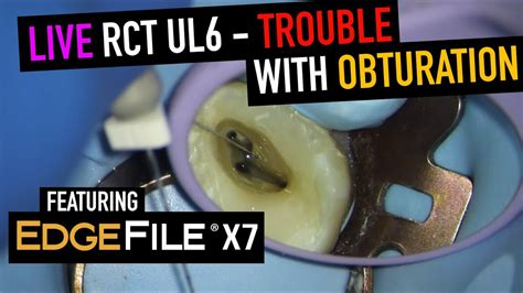 Edgefile X7 Review During Root Canal On Ul6 Is This File Too