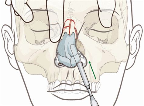 Nasal Fractures Causes Symptoms Diagnosis Treatment